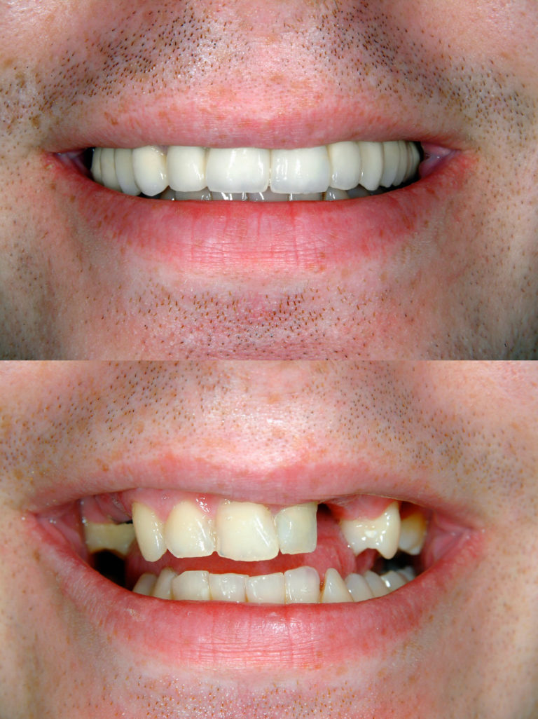Why It Is Important To Replace Missing Teeth Smile Essentials